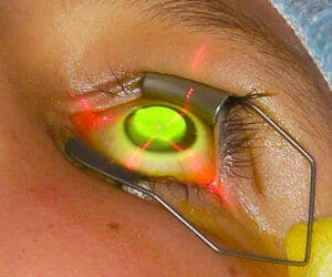 How To Prepare For Corneal Cross-linking Surgery | What To Know