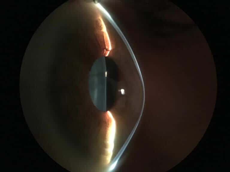 What is Keratoconus? Understanding Keratoconus Causes & Symptoms
