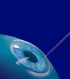 Advanced Corneal Transplants New Jersey | Keratoconus Teaneck