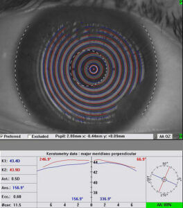Topography-Guided LASIK | Cornea & Laser Eye Institute Topography ...