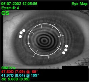 Keratoconus New Jersey | Conductive Keratoplasty New Jersey