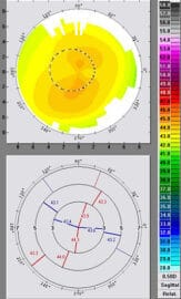 Topography-Guided LASIK | Cornea & Laser Eye Institute Topography ...